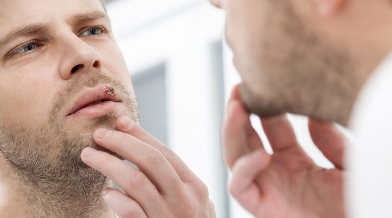 Mit Herpes Zum Zahnarzt